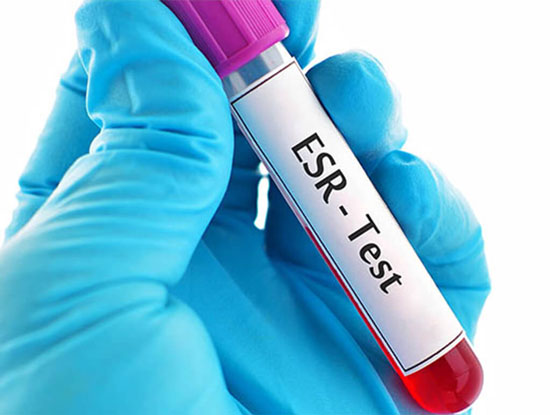 آزمایش ESR، تستی برای تشخیص عفونت و التهاب در بدن - آزمایشگاه ...